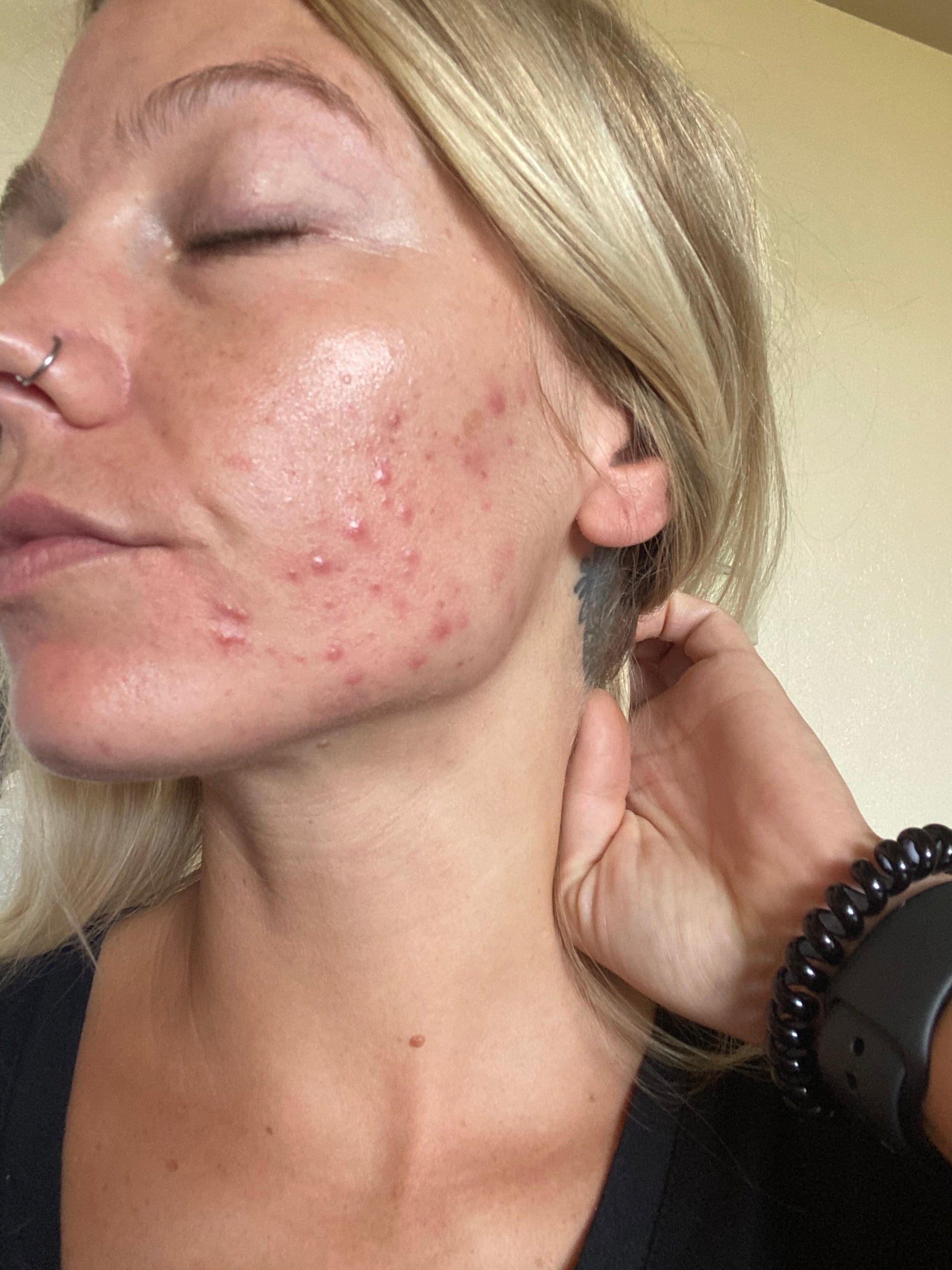 Types of Acne: Identifying and Managing | Averr Aglow®