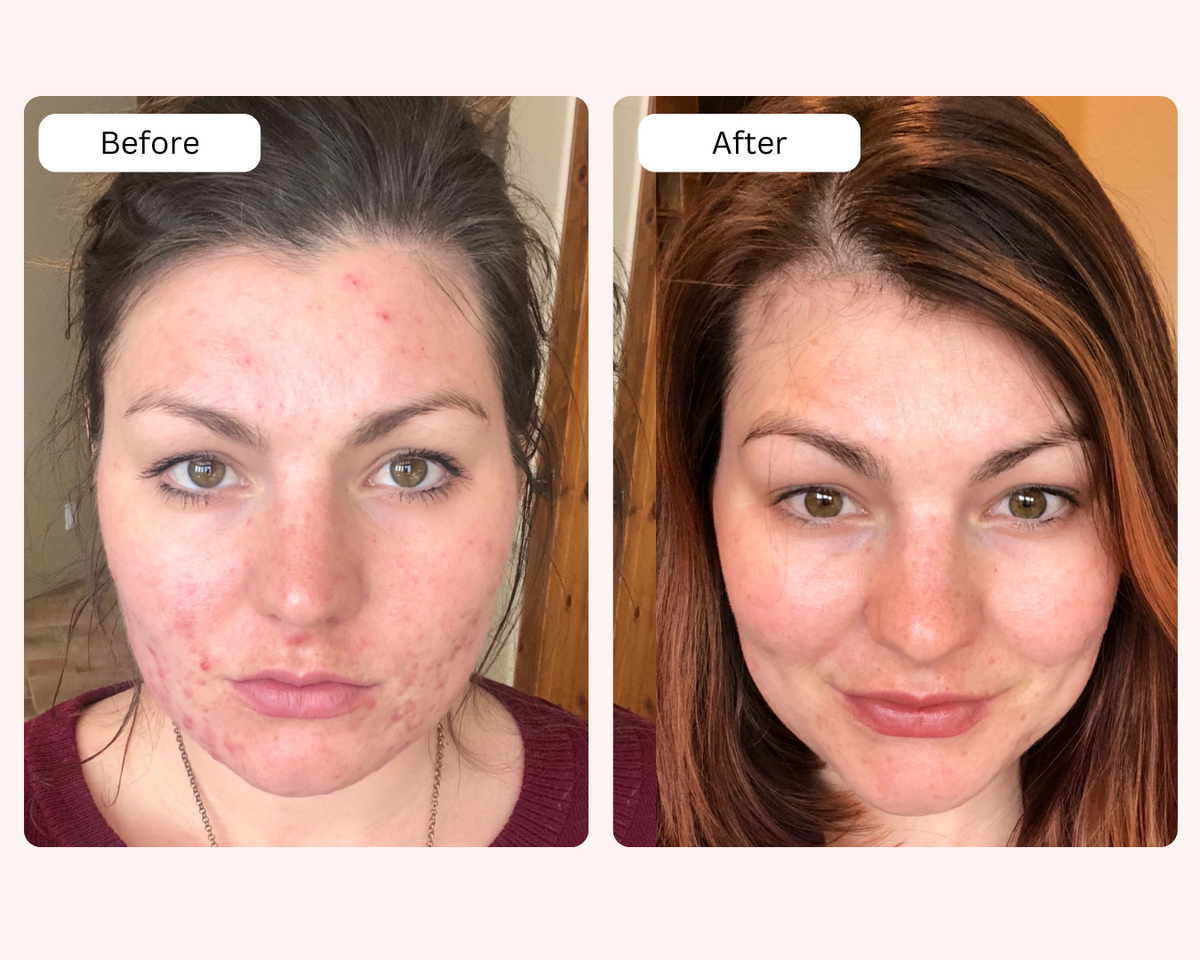 Clear Skin Elixir - - Acne Skin Care Products | Averr Aglow®