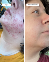 Clear Skin Elixir - - Acne Skin Care Products | Averr Aglow®