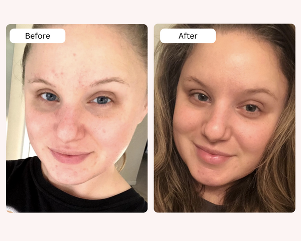 Clear Skin Elixir - - Acne Skin Care Products | Averr Aglow®