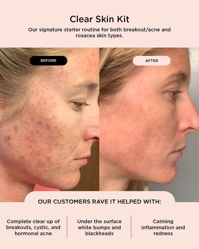 Clear Skin Acne Products | Natural Vegan Cruelty-Free Skincare