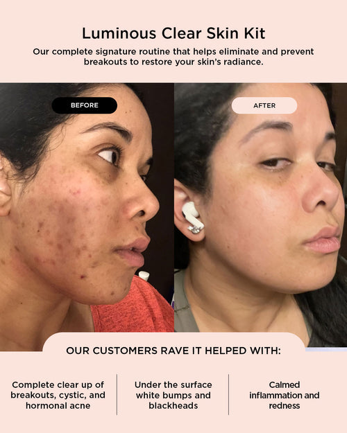 Clear Skin Acne Products | Natural Vegan Cruelty-Free Skincare