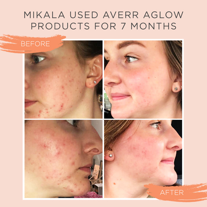 Clear Skin Elixir | Skin Care Masks | Acne Skin Care Products